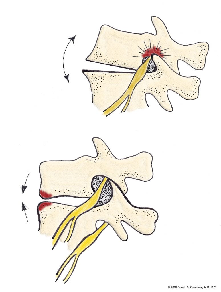 The true solution for your lower back pain - MSK Neurology