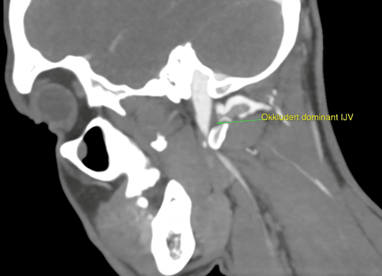 Intracranial hypertension: Beyond CSF. Diagnosis and treatment - MSK ...