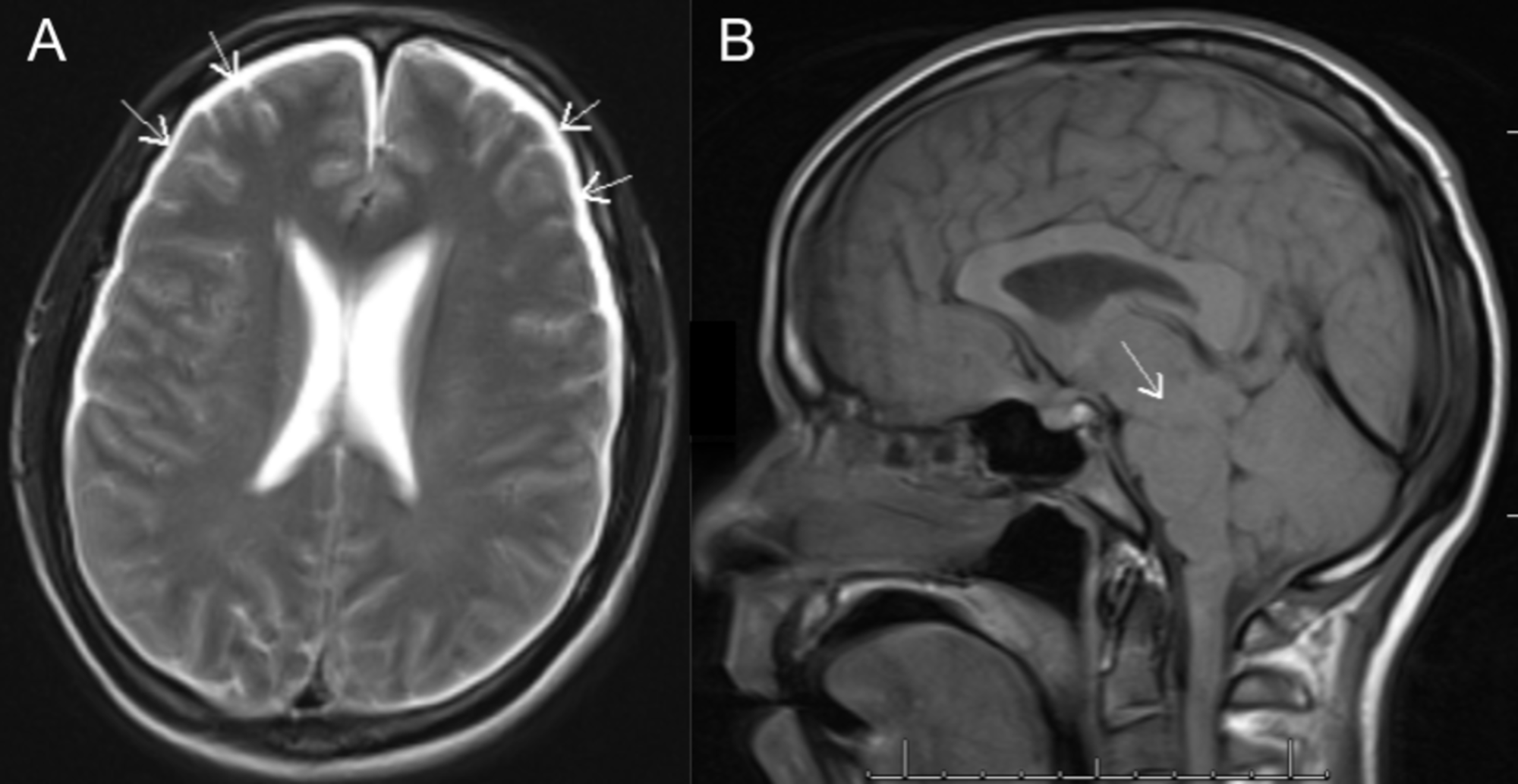 Intracranial hypertension: Beyond CSF. Diagnosis and treatment - MSK ...