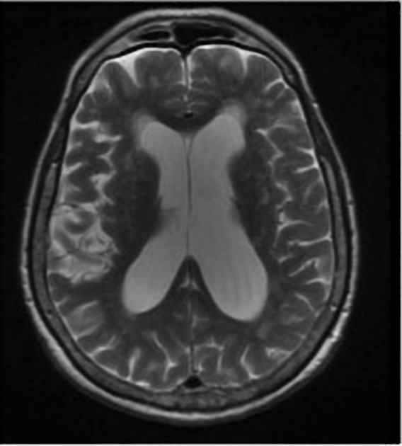 Intracranial hypertension: Beyond CSF. Diagnosis and treatment - MSK ...