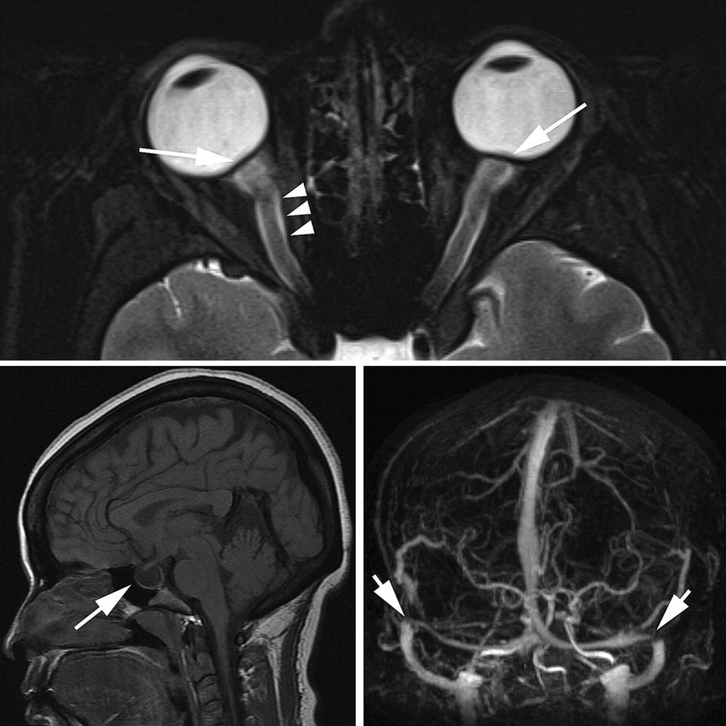 Intracranial hypertension: Beyond CSF. Diagnosis and treatment - MSK ...