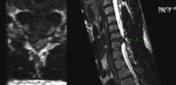 Chronic spinal pain and radiculopathy: Diagnostic approach and common ...