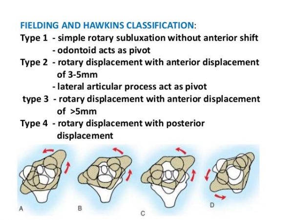 Do you really have atlantoaxial and craniocervical instability? A ...