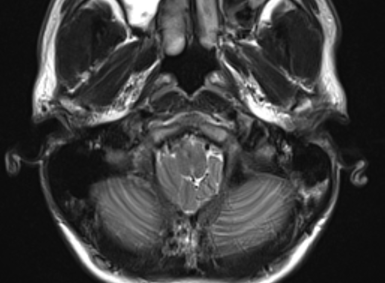 Do you really have atlantoaxial and craniocervical instability? A ...